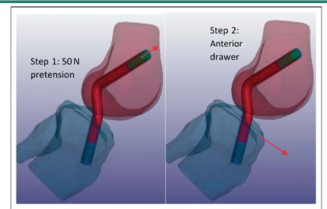 Figure 4 From The Hybrid Transtibial Technique For Femoral Tunnel