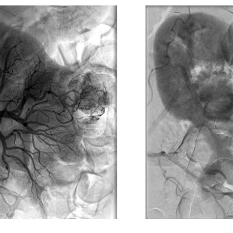 Selective Arterial Embolization Sae Procedure Using Nbca Lipiodol ® Download Scientific