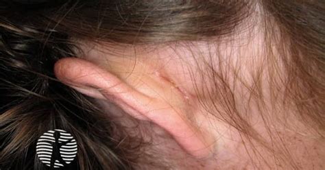 Psoriasis Of The Scalp Image