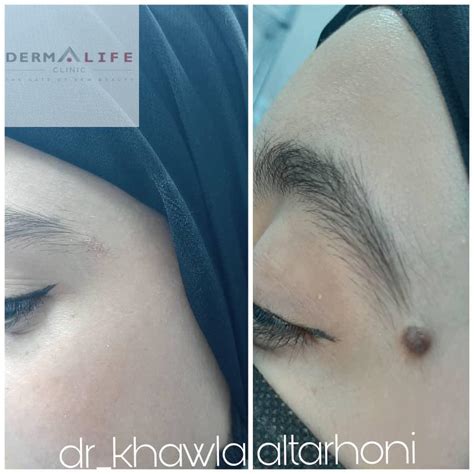 صورة قبل وبعد العملية Dermalife Clinic عيادة ديرما لايف
