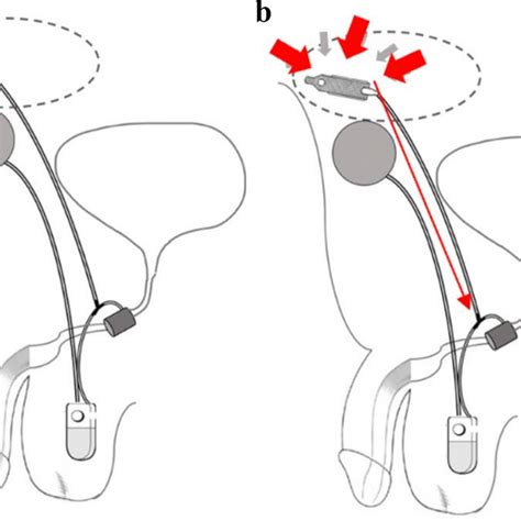 Design And Operating Principle Of AUS With SRR A The Principal And Download Scientific Diagram