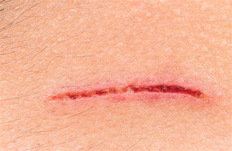 Heridas Y Quemaduras Bassa