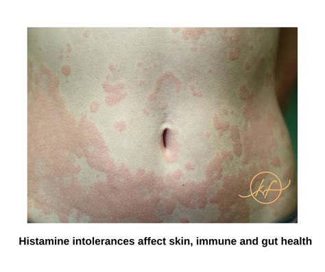 Understanding Histamine Impact On Your Immune System Skin Gut Healt