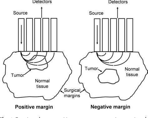 Figure 1 From Spatially Offset Raman Spectroscopy For Surgical Margin Evaluation During Breast