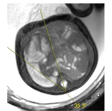 Figure 1 From Mediastinal Shift Angle In Fetal Mri Is Associated With