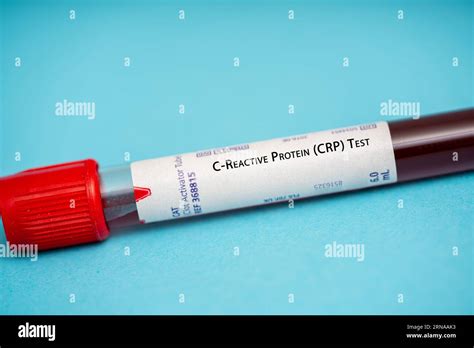 C Reactive Protein Crp Test This Test Measures The Levels Of Crp A Protein Produced By The