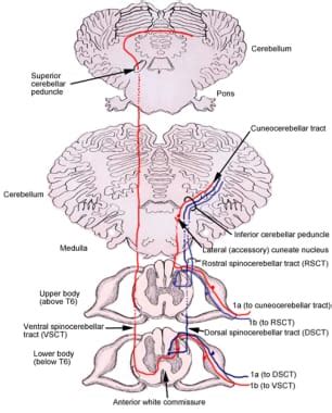 Spinothalamic Tract Lesion