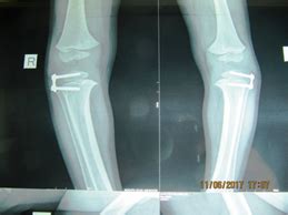 Genu Varum Professor Dr Mohammed Sobky Pediatric Orthopaedic