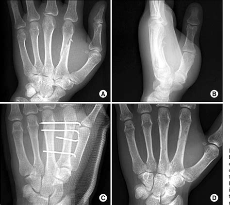 Figure 1 From Treatment Of Metacarpal Fractures Using Transverse Kirschner Wire Fixation