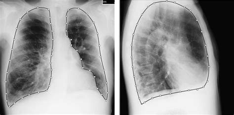 Figure 2 From Computer Aided Diagnosis Of Emphysema In Copd Patients Neural Network Based