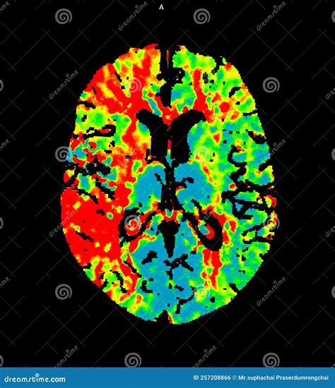 Axial View Of Ct Perusion Of The Brain Stock Illustration Illustration Of Medical Tomography