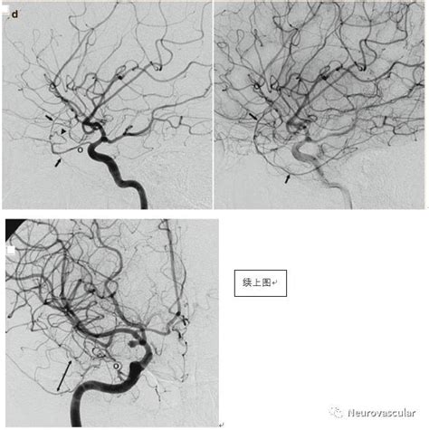 脑血管造影读片基础图谱——颈内动脉、颈外动脉、主动脉弓 脑医汇