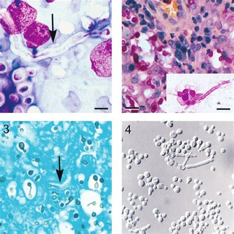 Pdf Temperature Sensitive Strain Of Cryptococcus Neoformans Producing Hyphal Elements In A