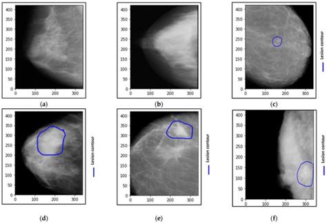 A Hybrid Workflow Of Residual Convolutional Transformer Encoder For