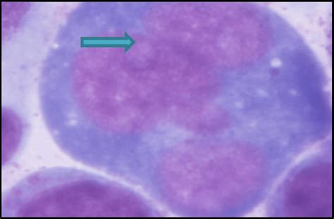 Bone Marrow Aspirate Erythroid Precursors Consist Of Basophilic
