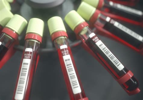 Syphilis Test And Stis Sexual Health Clinic Perth