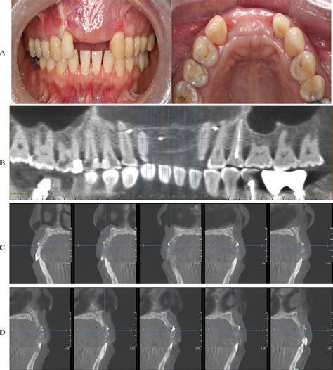Healing And Bone Resorption Revealed By Cone Beam Ct At 4 Months Download Scientific Diagram