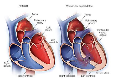 Ventricular Septal Defect Conditions Leeds Congenital Hearts