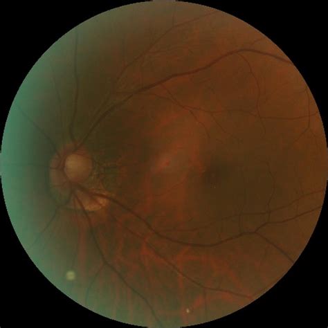 eye diseases classification dataset by indian servers