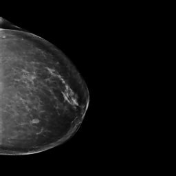 Breast Tumor Detection Object Detection Dataset By BrCancerYOLOv7