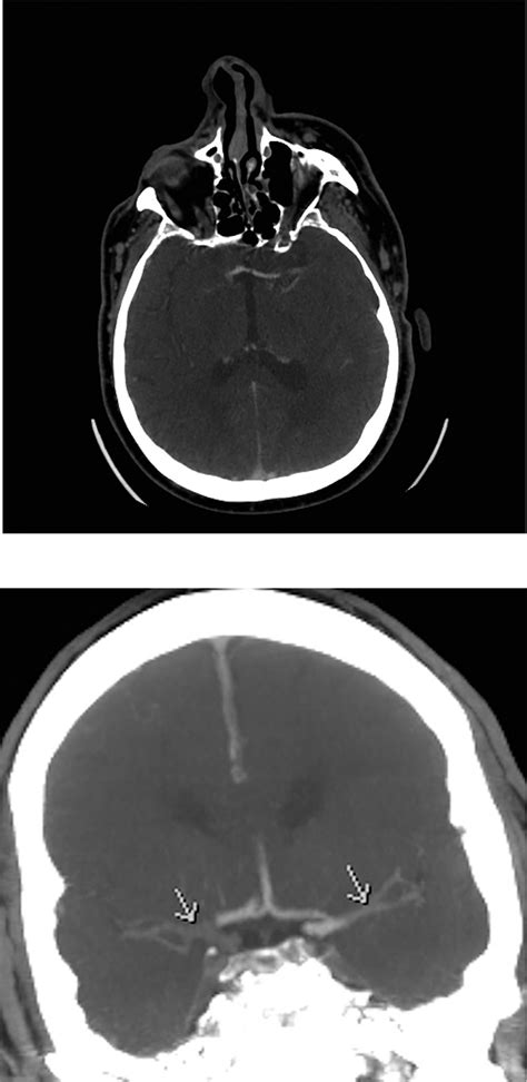 Bilateral Middle Cerebral Artery M1 Segment Occlusion Axial A And Download Scientific