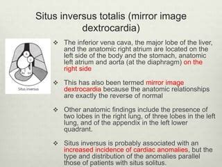 Dextrocardia Pptx