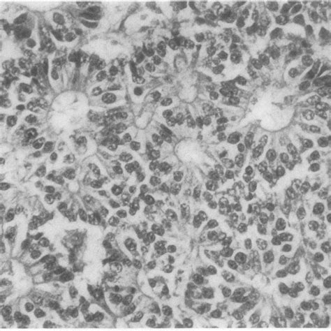 Tumour Showing Rosette Formations H And E X40 Download Scientific