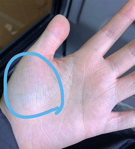 손바닥 통증 지식in