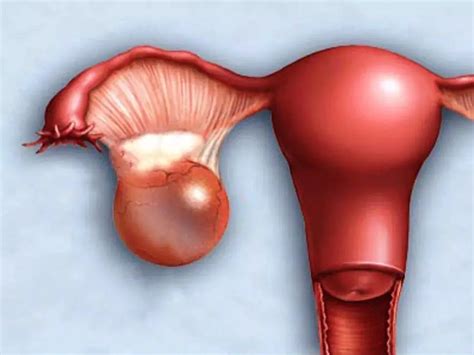 Cyst On The Ovary Symptoms Possible Causes Diagnosis And Treatment
