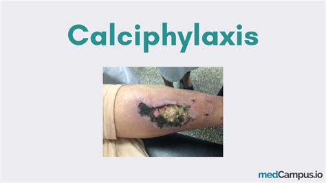 Calciphylaxis Cua Youtube