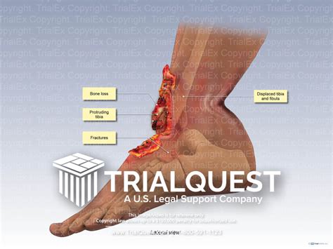 Open Left Ankle Dislocation Trial Exhibits Inc