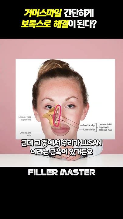 거미스마일 간단하게 보톡스로 해결이 된다 Youtube