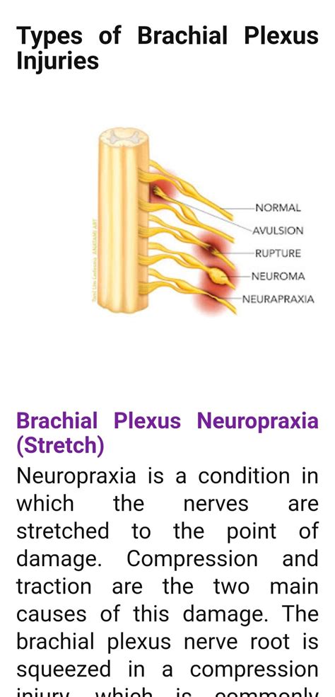 Types Of Brachial Plexus Injuries How Many Types Of Brachial Plexus