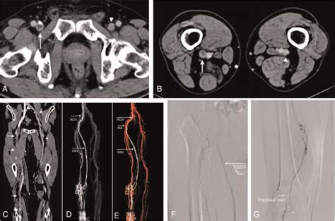Cpt Ct Venogram