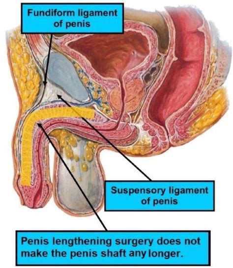 Penis Lengthening Surgery Androfill Penis Filler Usa