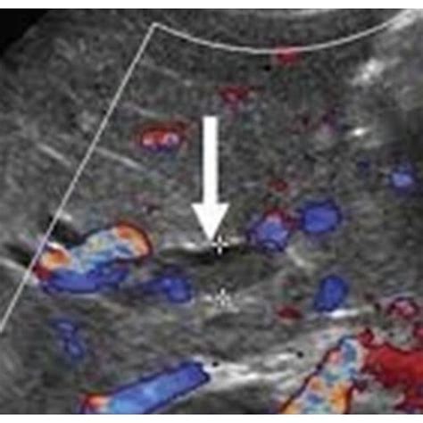 Abdominal Ultrasound At Day Of Life 20 Biliary Sludge In Dilated