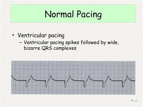 Temporary Pacemaker 2 Pptx Pptx