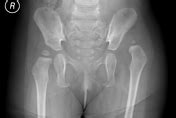 Viewing Playlist GD Paediatrics MSK Hip Pelvis Radiopaedia Org