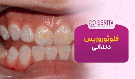 فلوئوروزیس دندانی چیست؟ علل ایجاد و راه های درمان و پیشگیری