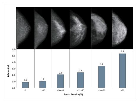 Benign Breast Disorders New England Journal Of Medicine