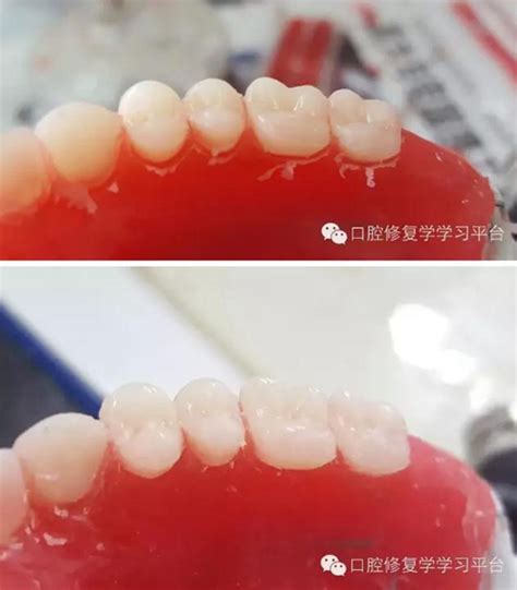 全口义齿的制作：基托修整 科贸嘉友收录 义齿技术 陕西嘉友科贸有限公司