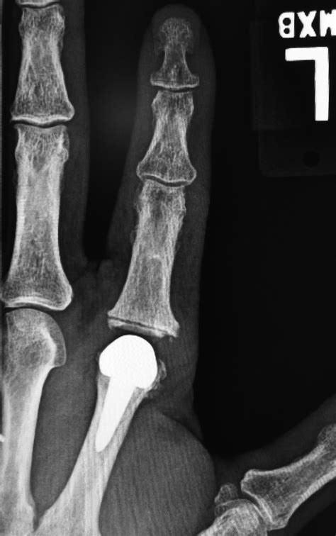 Medical Apparatus Imaging Guide Joint Arthroplasty