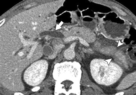 Mimics Of Cholangiocarcinoma Spectrum Of Disease Radiographics