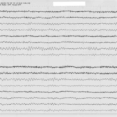 The Electroencephalography Recorded One Day After The Episode Showed