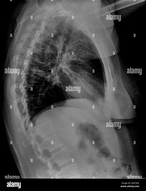Lateral Chest X Ray Pneumonia Chest X Ray Image View Classification