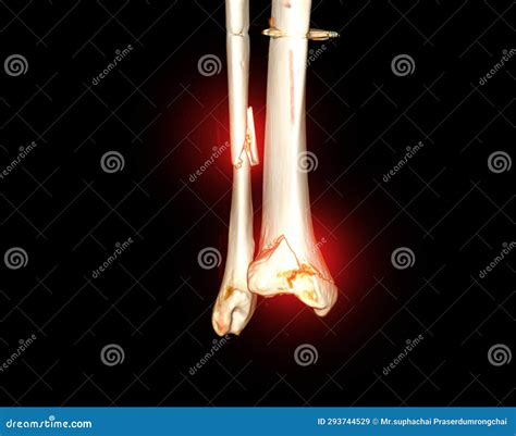 Ct Scan Ankle Joint 3d Rendering Image Showing Fracture Tibia And Fibula Bone Stock Illustration