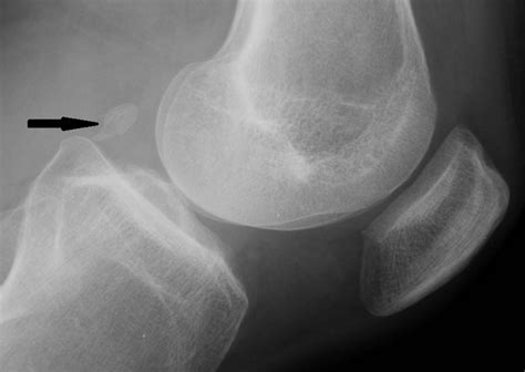 Fracture Of The Fabella With Radiologic And Mri Bmj Case Reports