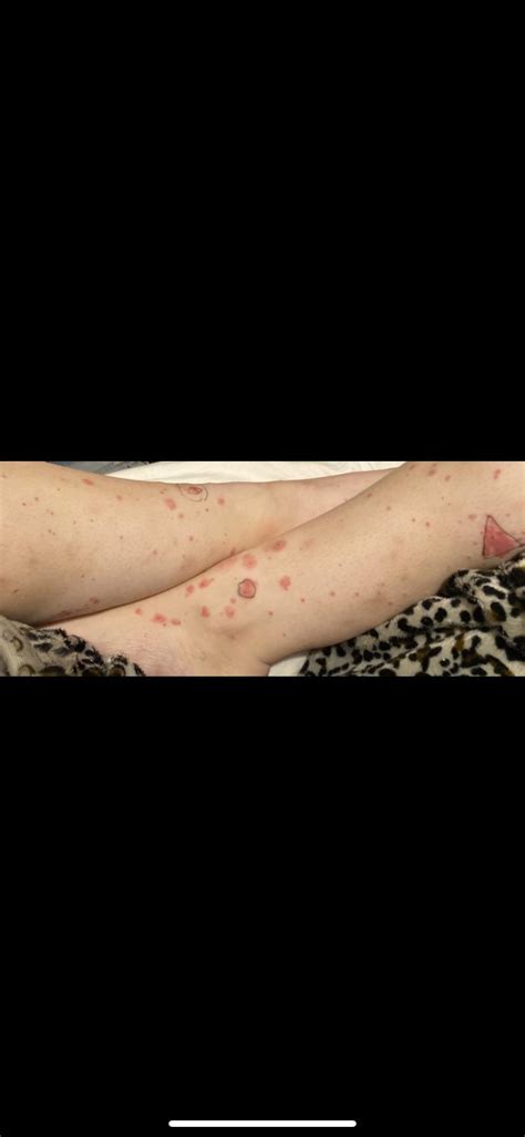 Non Blanching Rash Doctors Said It Didnt Look Like Meningitis And 2