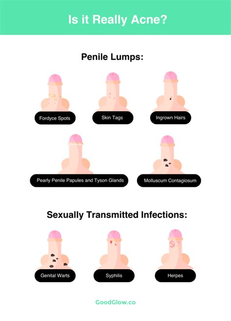 How To Treat And Prevent Whiteheads On Penis Goodglow