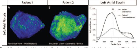 Left Atrial Structure Semantic Scholar
